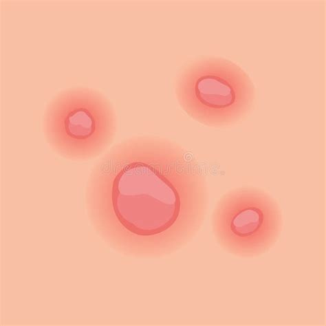Understanding Type Of Acne A Comprehensive Visual Guide For Everyone Stock Vector Illustration