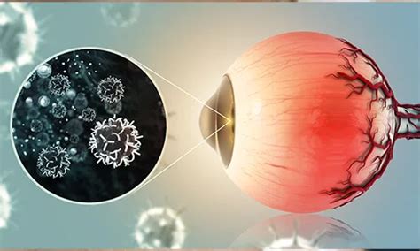 Eye Cancer Symptoms Diagnosis Treatment And Types Moc