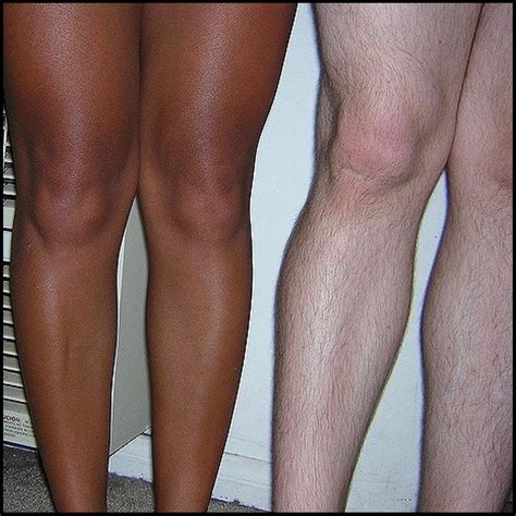 Knee Evaluation Boulder Chiropractic Clinic