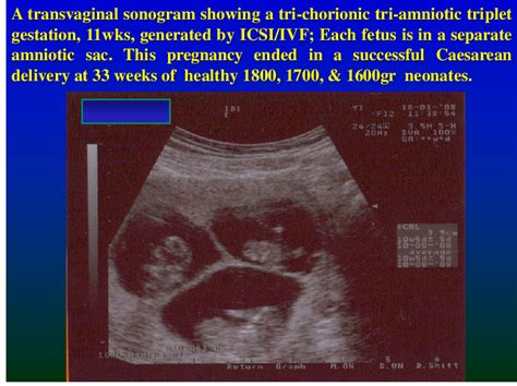 Sonogram Triplets Twin Ultrasound Images From Every Trimester