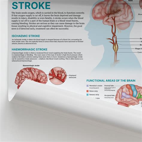 Stroke Brain Poster Types Effects And Treatment Education Anatomystuff