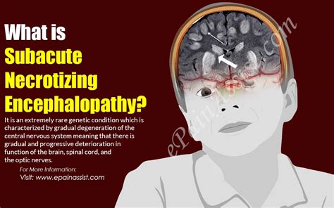 Encephalitis Symptoms