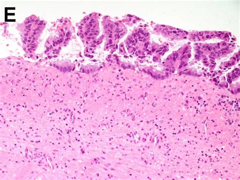 E Histopathological Examination Of Borderline Mucinous Tumour Of The