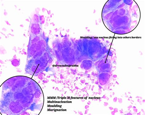 Tzanck Smear Original Article Evaluation Of Sensitivity Of Tzanck