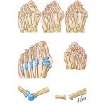 Surgical Reconstruction Of Severe Rheumatoid Forefoot Deformity