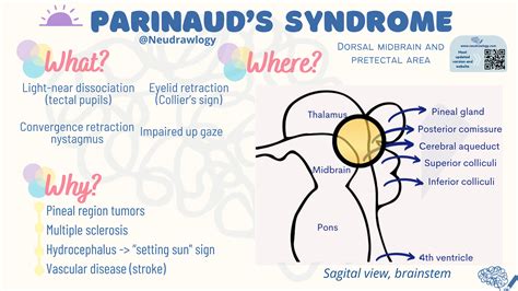 Sindrome Oculoglandular De Parinaud Case Series Of Parinauds