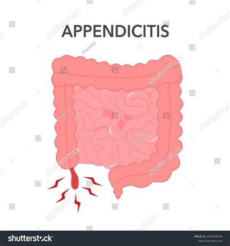 Appendicitis Concept Vector Illustration Inflammation Appendix Stock