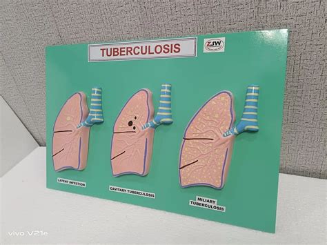 The Tuberculosis Model At ₹ 2250 Piece Sadar Bazar Ambala Id 2856095232662