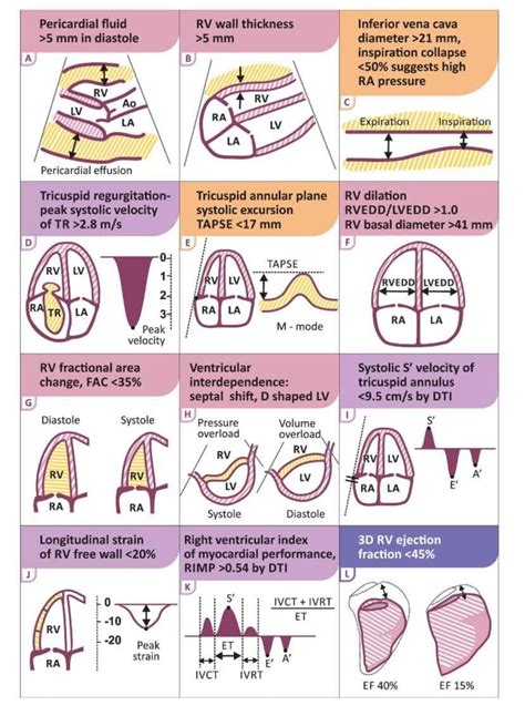 Cardio Graphic Representation Of Pocus Parameters For Rvf Assessment