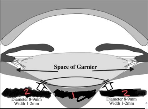Vitreous Flashcards Quizlet