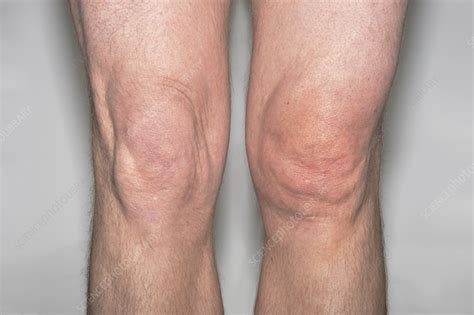Housemaids Knee Photos