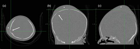 Caput Succedaneum Radiology