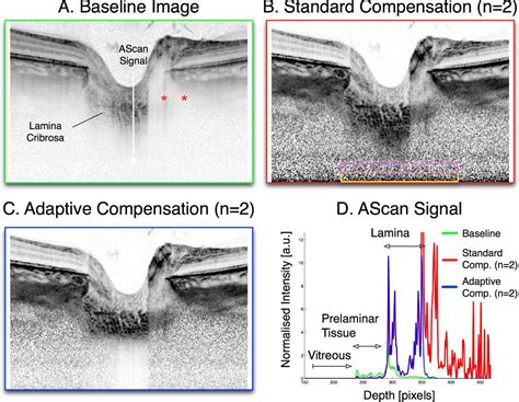 Figure 1 From Enhancement Of Lamina Cribrosa Visibility In Optical