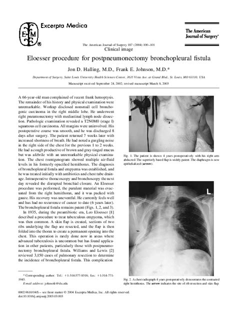 Pdf Eloesser Procedure For Postpneumonectomy Bronchopleural Fistula