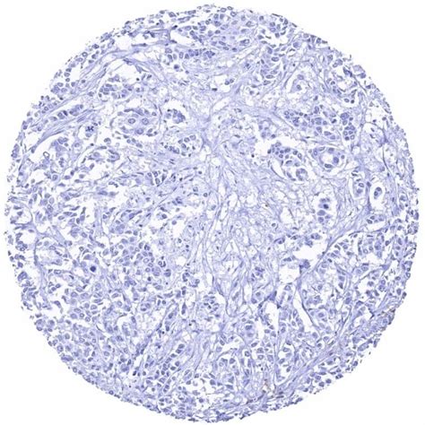 Cancer Tissue Gallery Cd38 Ms Validated Antibodies