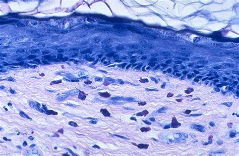Mast Cells Showing Metachromasia Wrights Stain Stains Mast Cell Medical Education