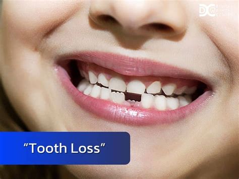 Tooth Loss Treatment Your Guide To Restoring Your Smile