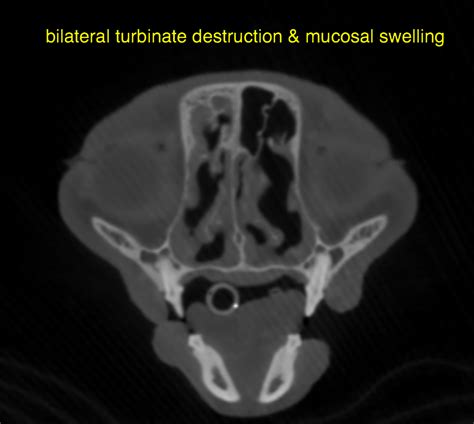 Ct Bilateral Chronic Destructive Rhinitis With Secondary Sinusitis