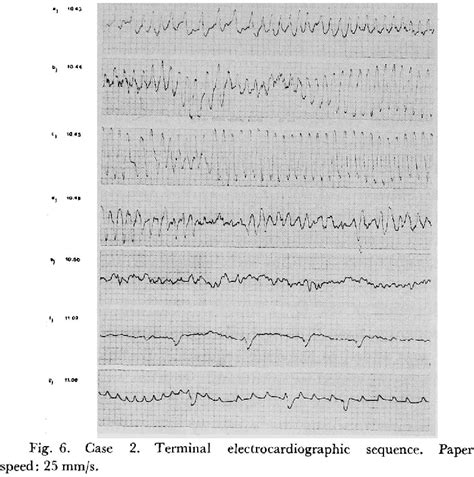 Figure 3 From Sudden Cardiac Death During Ambulatory Holter Monitoring