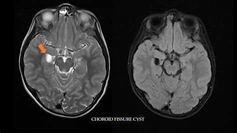 Ultimate Radiology Choroid Fissure Cyst