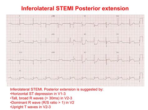 St Segment In Ecgst Elevation And St Depression Pptx