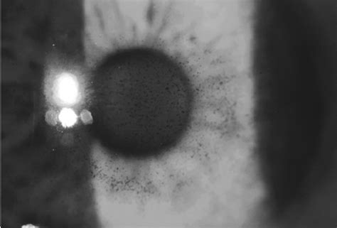 Ocular Surface Lesion Staining With Rose Bengal Download Scientific