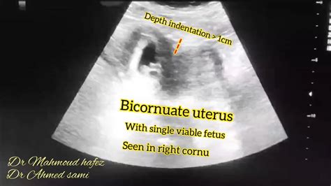 Ultrasound Of Bicornuate Uterus With Single Viable Fetus In The Right