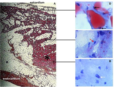 Arrhythmogenic Right Ventricular Cardiomyopathy Arvc Histology A