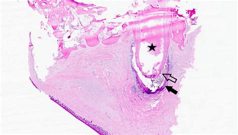 Radicular Cyst Pathology Outlines Pathology Outlines Dermoid Cyst