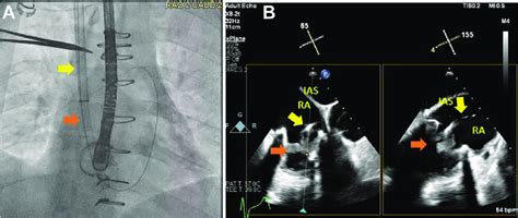 A X Ray Fluoroscopic Anteroposterior Projection Image Demonstrating A Download Scientific