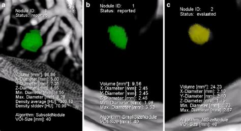 The Same Nodule Analysed At The Same Time With The Subsolid A Small