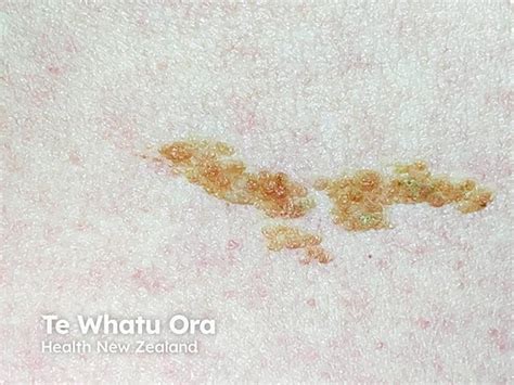 Keratinocytic Epidermal Naevus Images