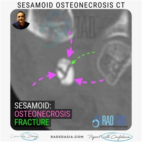 Sesamoid Osteonecrosis Radiology Xray Mri Radiology Education Asia
