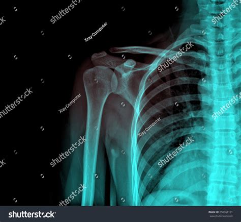 X Rays Of Shoulder Dislocation At Tom Merriman Blog