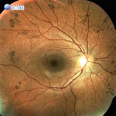 Bear Tracks Retina
