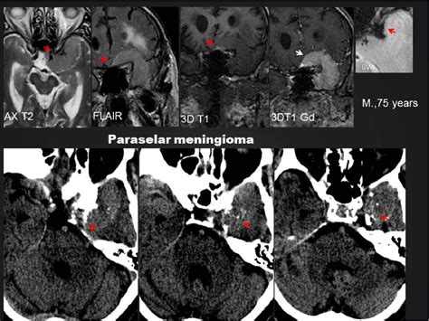 Figure 22 From Computed Tomography Patterns Of Intracranial Calcifications Always Easy To