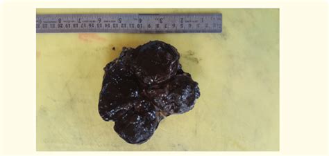 Large Pigmented Left Inguinal Lymph Node After Excision Download