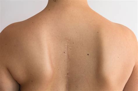 Scoliosis Surgery And Recovery Baptist Health