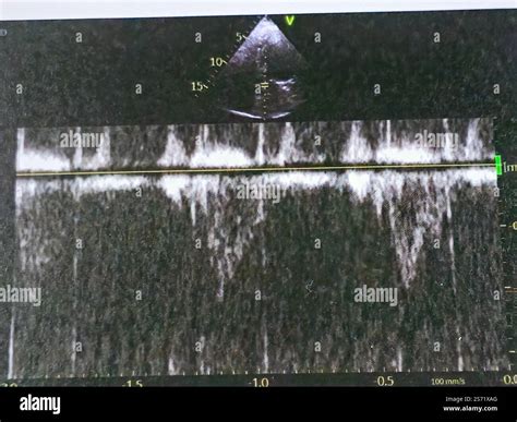 Echocardiography Or Cardiac Ultrasound Shows Normal Values Except For Left Ventricular