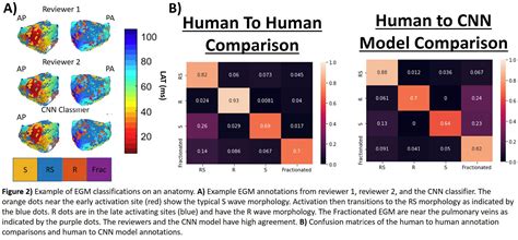 Po 639 07 Automatic Unipolar Electrogram Morphology Analysis Using A Convoluted Neural Network