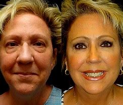 Cost Facelift In Mexico 2025 Topplasticsurgeonsmexico