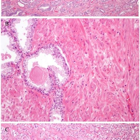 Patterns And Heterogeneity In Cancerous Prostate Tissue Hematoxylin