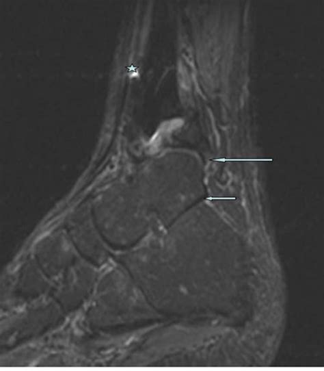 Clinical Review Of Adhesive Capsulitis Of The Ankle An Introductory