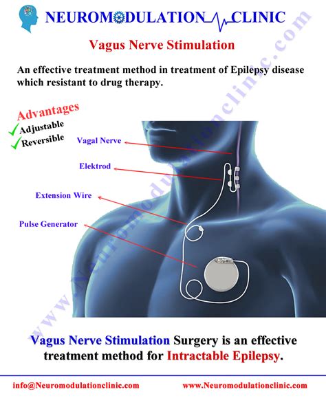 Vagus Nerve Stimulation In Epilepsy