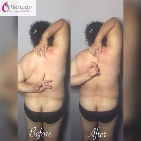 🎉🎉🎉一次见效🎉🎉🎉 《何为脊柱侧弯》 脊柱侧弯是脊柱的非正常弯曲。 正常的脊柱在肩部有向后的弯曲，而在腰部有向前的弯曲。典型的脊柱侧弯包括三维的脊柱和肋骨畸形。 根据度数的变化，脊柱从侧面