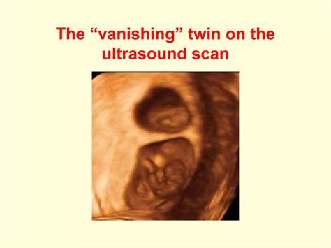 Towards A Psychological Profile For Womb Twin Survivors Ppt