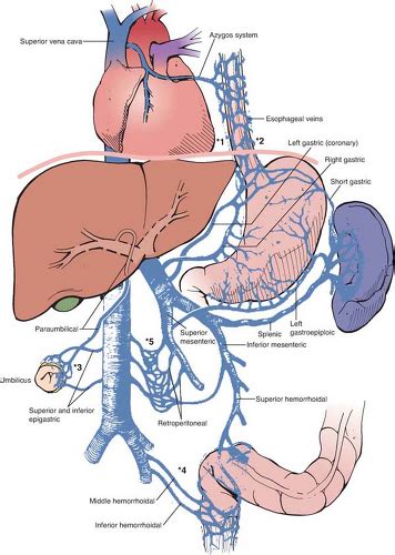 Portacaval Anastomosis Diagram