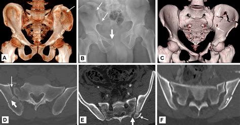 High Energy Pelvic Ring Injuries A Comprehensive Imaging