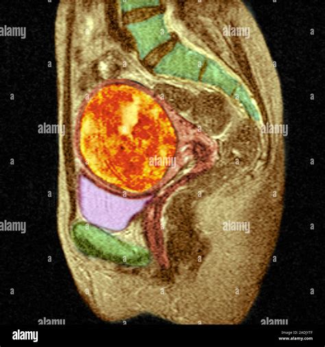 Uterine Fibroid Coloured Magnetic Resonance Imaging Mri Scan Of A