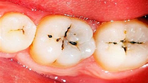 Tooth Cavity Symptoms Causes And Treatment